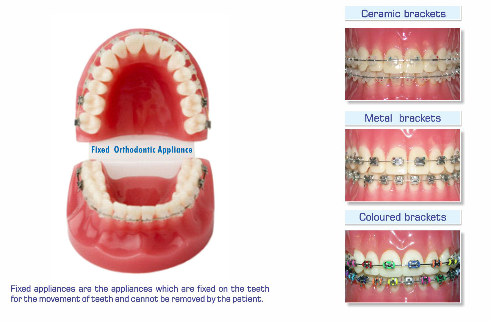 Services - Orthodontics | Dr.Murali's Dental Care