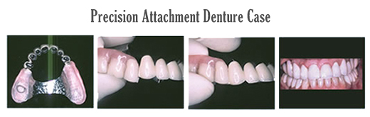 Services - Precision attachment | Dr.Murali's Dental Care